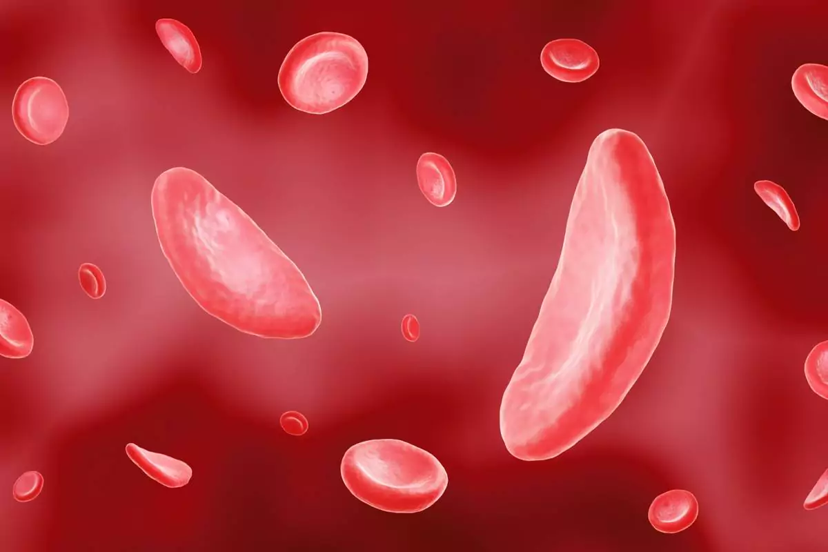 Quel sera le prochain traitement contre la drépanocytose